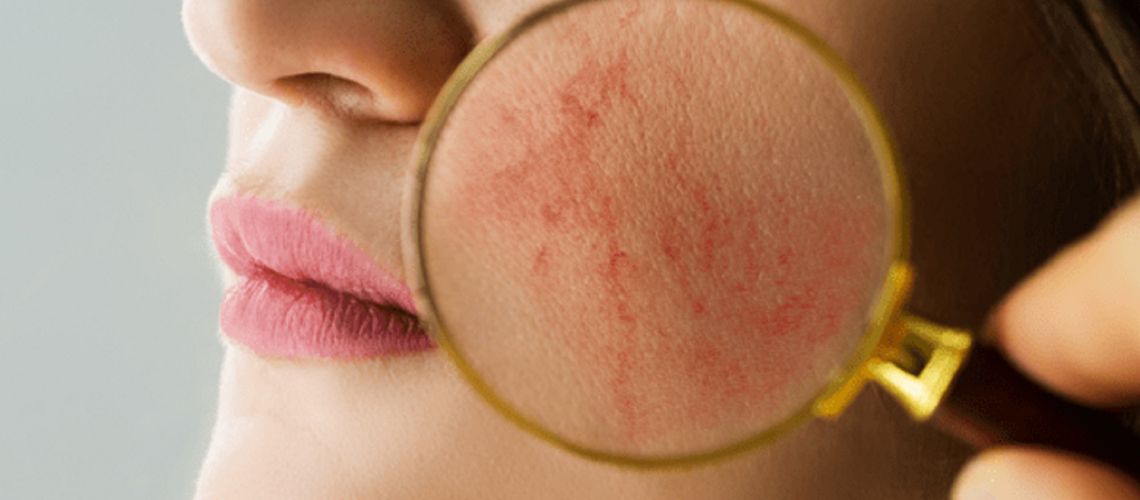 Unraveling the Mystery of Skin Rashes: Causes, Symptoms, and Solutions ...